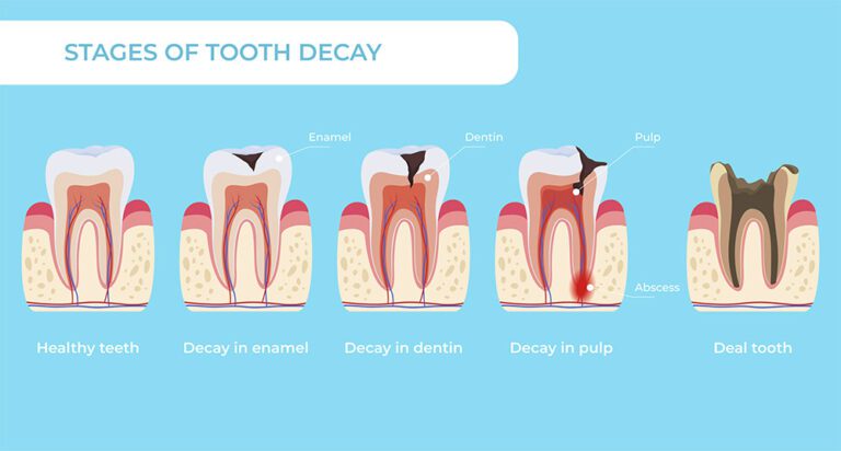 What's a Dental Cavity – symptoms and causes, Tooth Decay Treatment